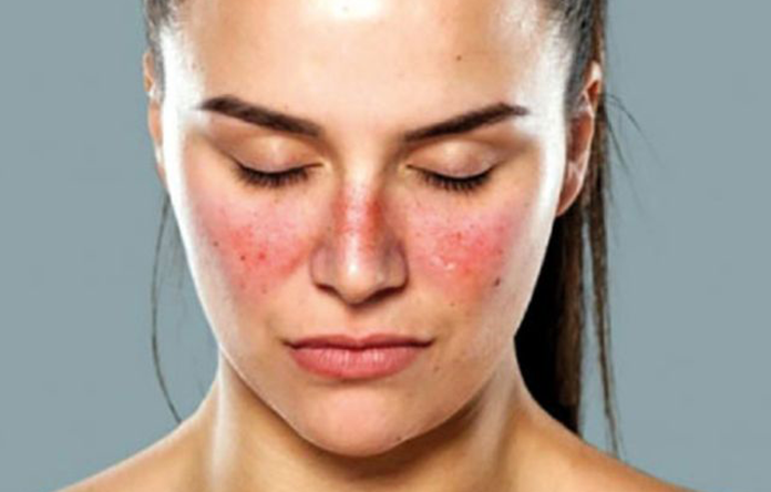 Peran Genetik pada Penyakit Autoimun SLE