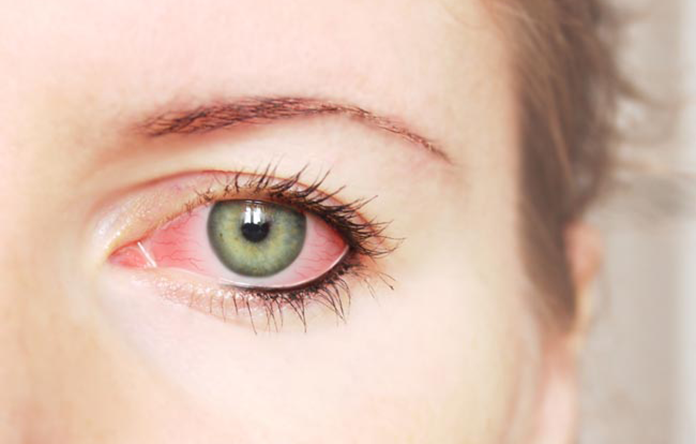 Gunakan Obat Mata Merah Berdasarkan Penyebabnya